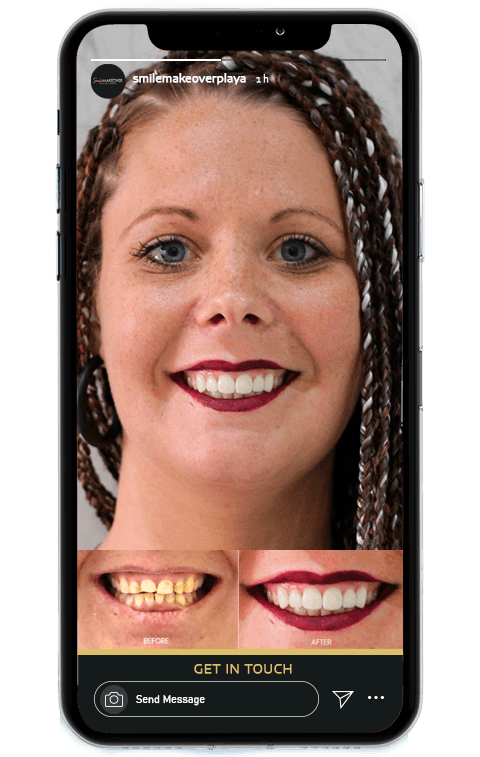 Smile Makeover Playa del Carmen - Smile Design - Dental Tourism Mexico