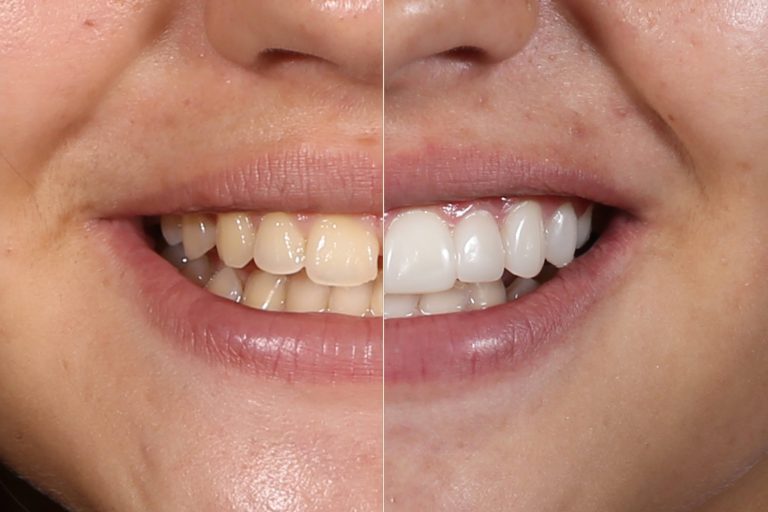 Smile Makeover Mexico ⋆ Dental Makeover ⋆ Playa del Carmen Dentist